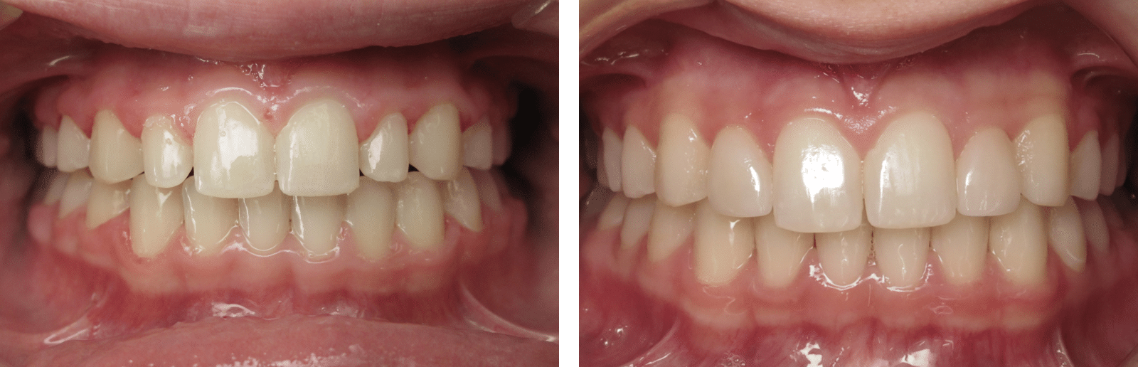 Build Ups in Puyallup & Graham, WA | Smiles Orthodontics