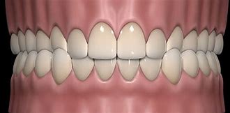 Can Invisalign Fix Crossbite? How Effective Are Clear Aligners?